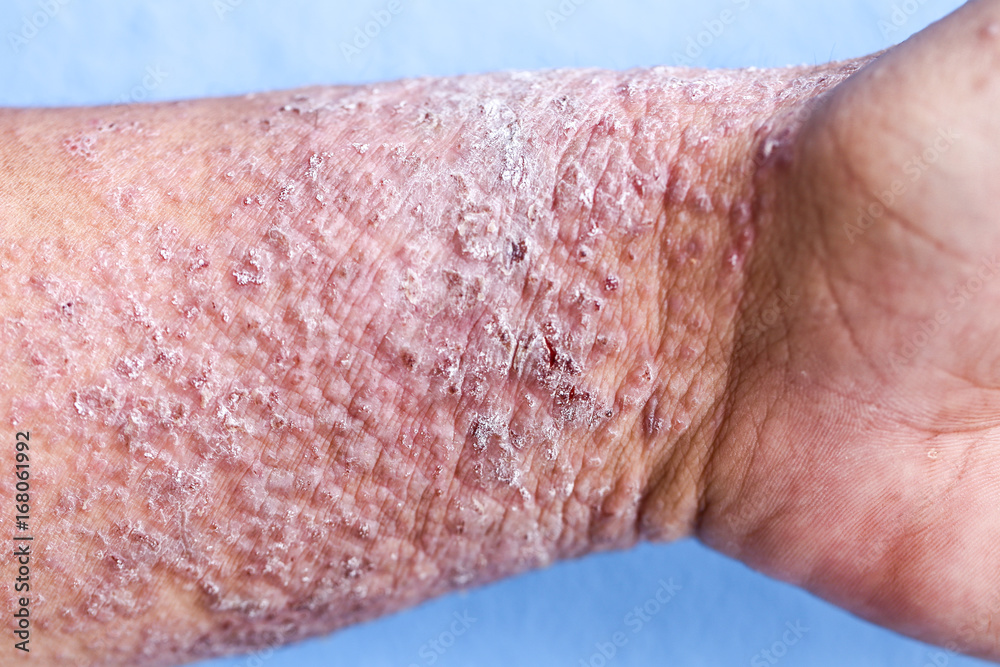 Atopic dermatitis (AD), also known as atopic eczema, is a type of ...