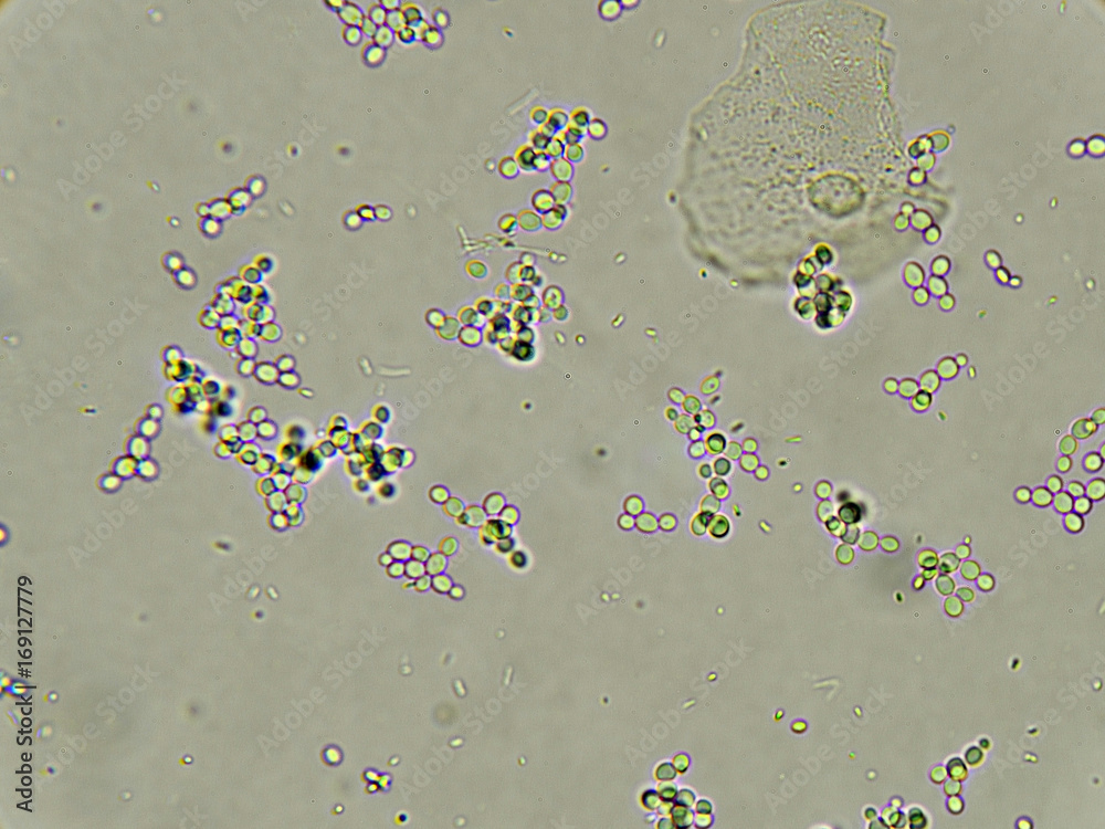 Budding yeast cells in patient urine (urinary tract infections), analyze by microscope, contrast ...