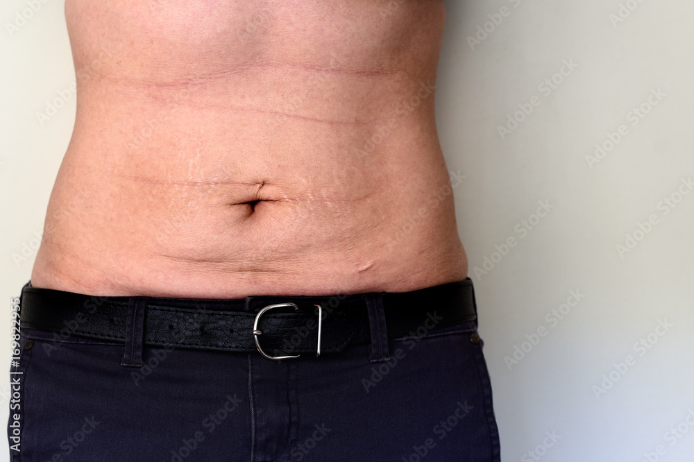 Woman belly with stretch marks and scars Stock Photo | Adobe Stock