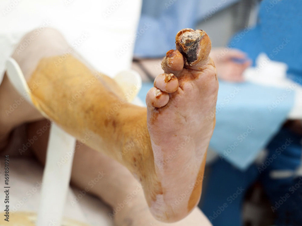 Diabetic foot syndrome. Gangrene of the big toe. General view Stock ...