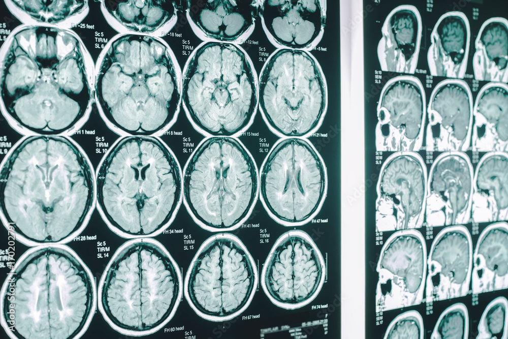 Photo Stock brain on film MRI Adobe Stock