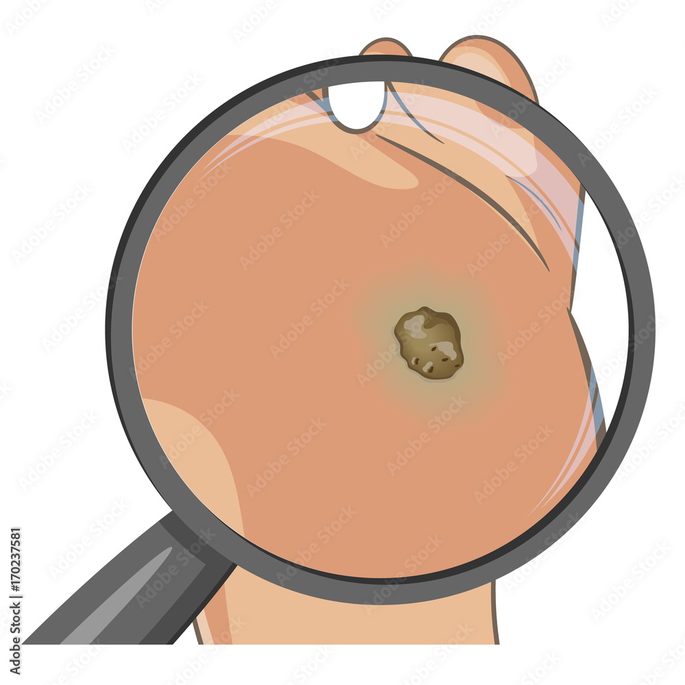 Foot wart magnified with glass. Foot bottom pathology: verruca, wart ...