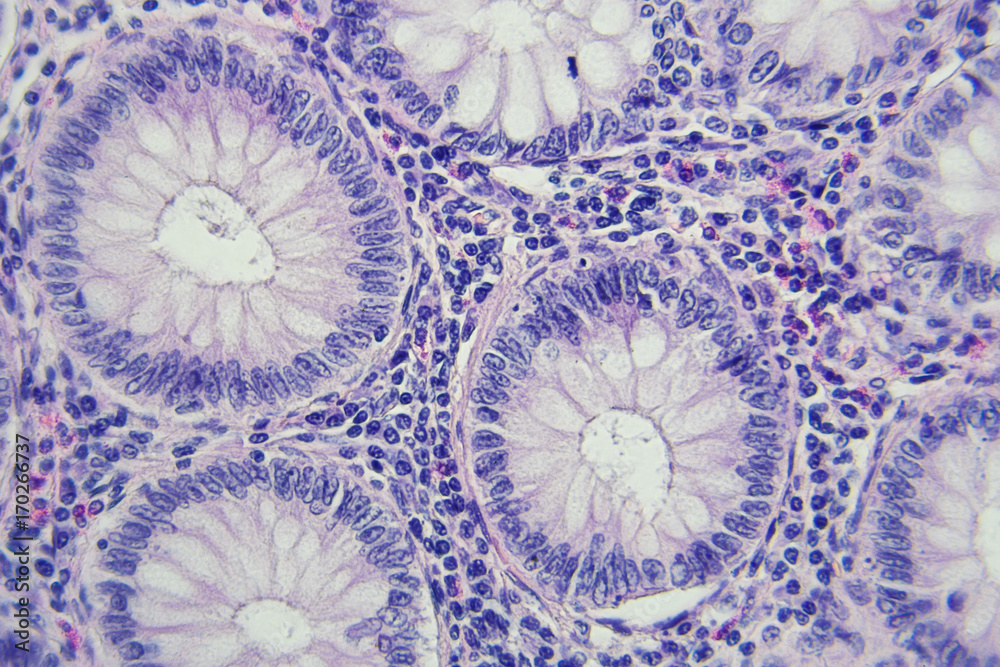 Colon cancer microscopic photography, magnification x400 Stock Photo ...