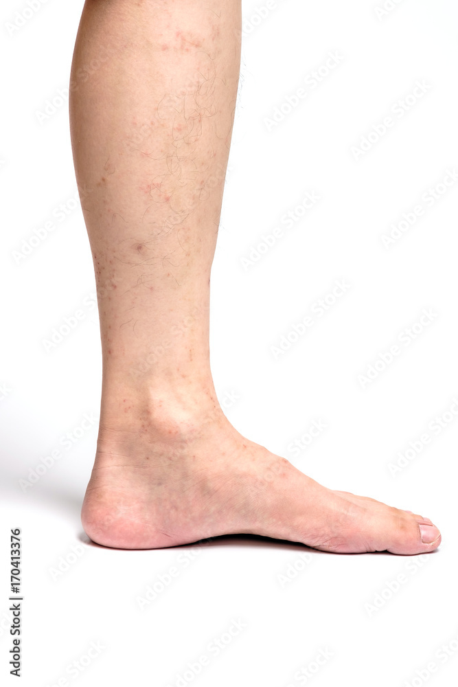 Allergic rash dermatitis eczema skin of patient legs Stock Photo ...