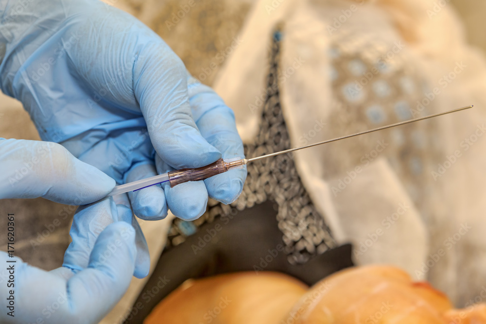 Detail of polylactic acid filament inside the cannula to perform facial ...