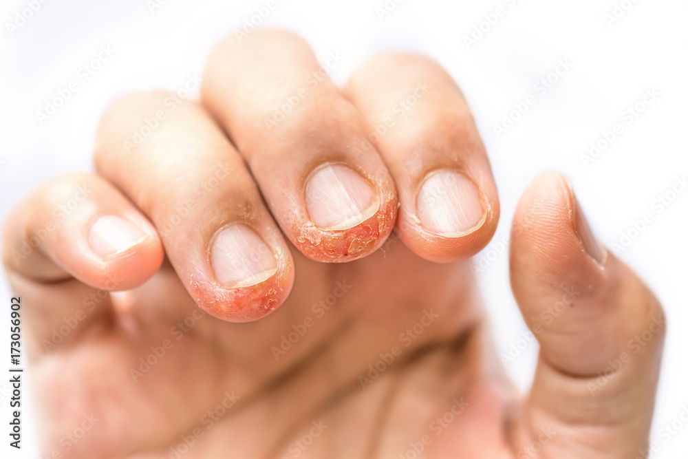 Advanced stage of dyshidrosis on fingers,cracked and peeling skin ...