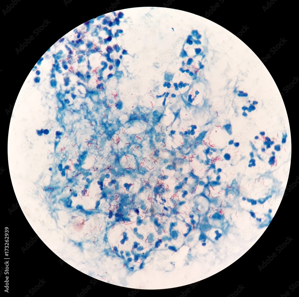 Fotografie Smear of Acid-Fast bacilli (AFB) stained from human body ...