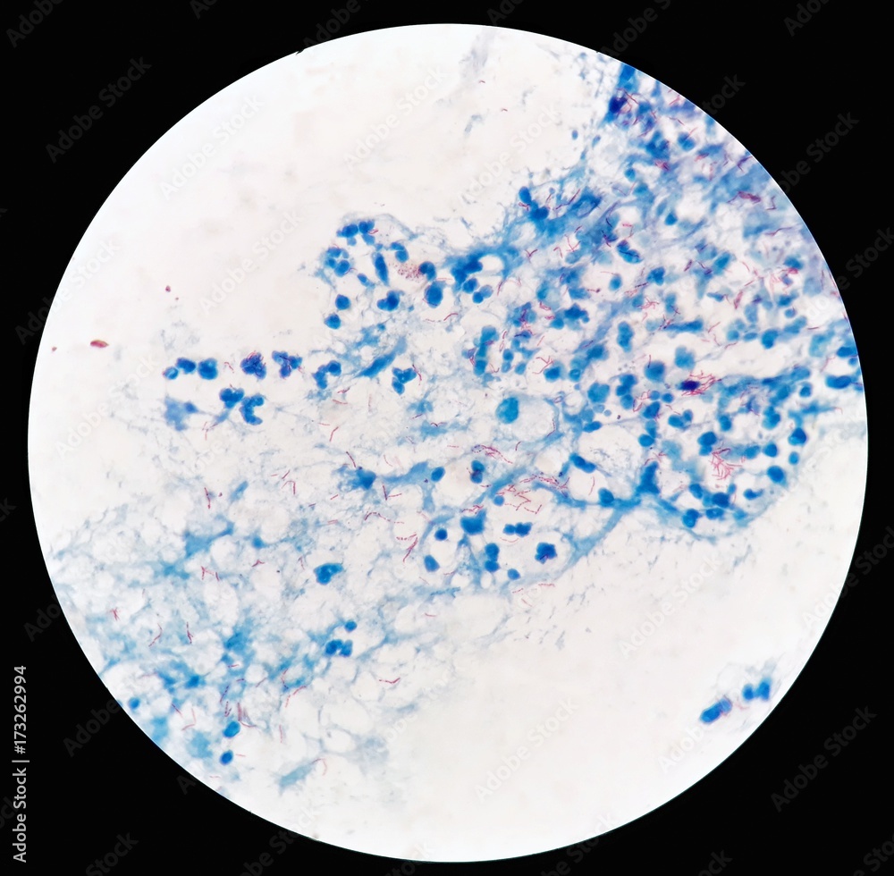 Smear of Acid-Fast bacilli (AFB) stained from human body fluid specimen ...