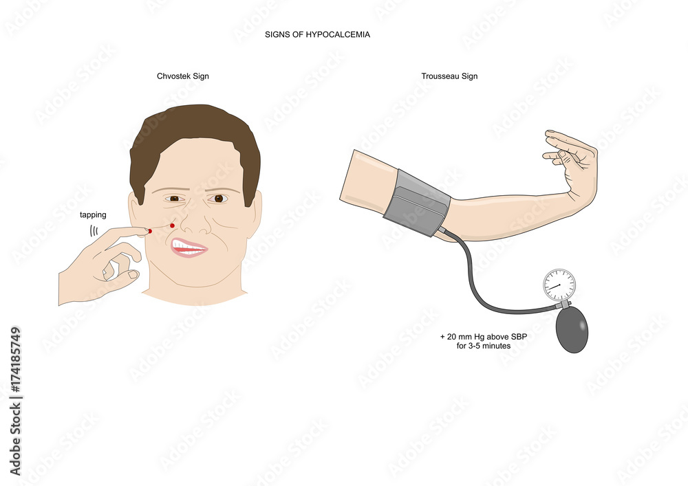 Two neurological test to evaluate the presence of hypocalcemia ...