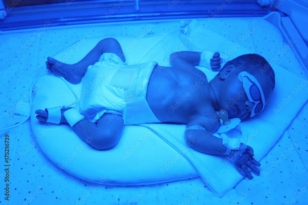 Newborn baby under blue UV light for phototheraphy on infant warmer in ...