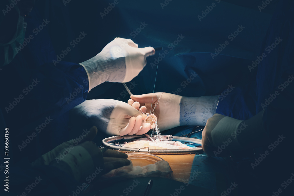 Team of surgeons minimally invasive aortic valve surgery replacement ...