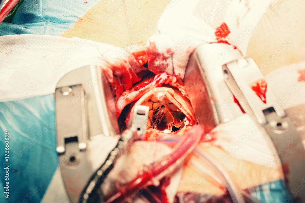 minimally invasive surgical approach with a small incision for heart ...