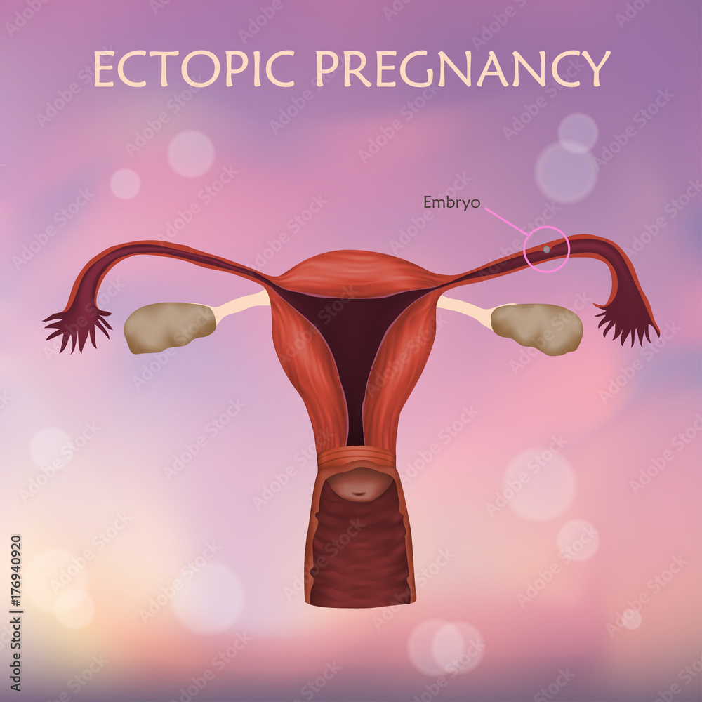 Ectopic Pregnancy The Fertilized Egg Uterus Womb Anatomy 9348
