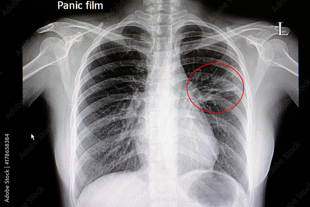 Chest x-ray film of patient with pneumonia Stock Photo | Adobe Stock
