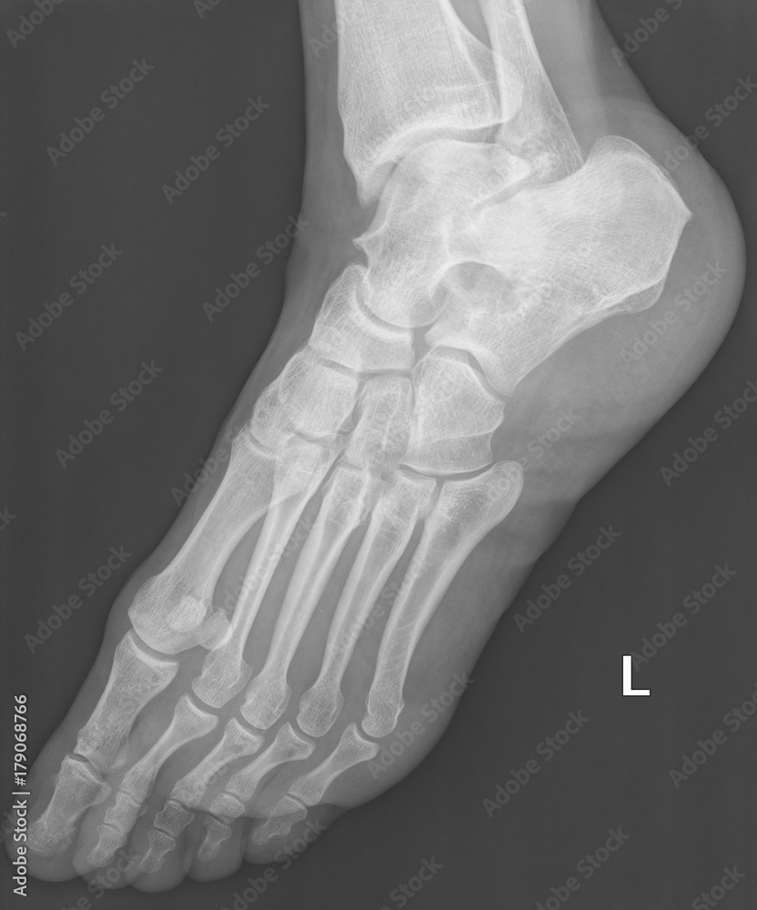female feet xray radiograph Stock Photo | Adobe Stock