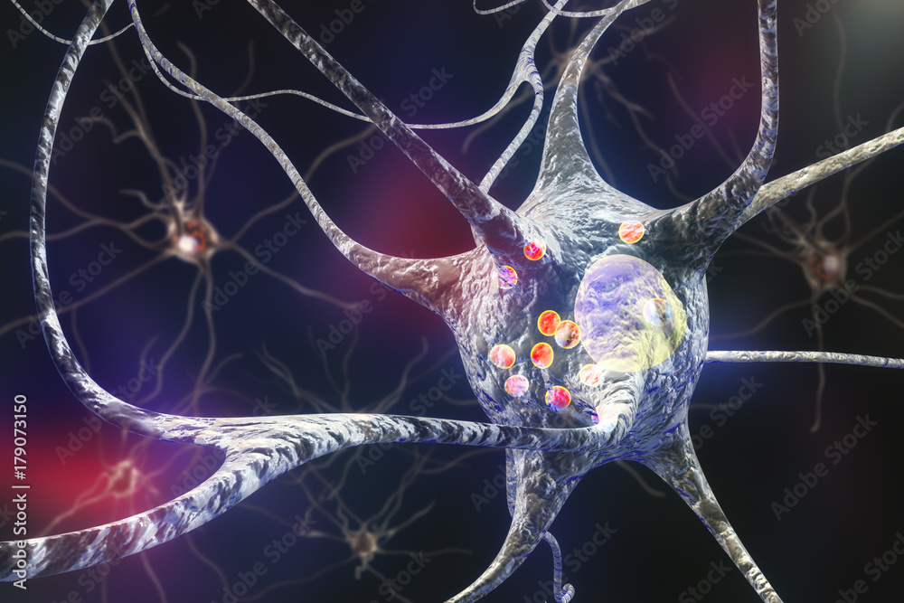 Parkinson's disease. 3D illustration showing neurons containing Lewy ...