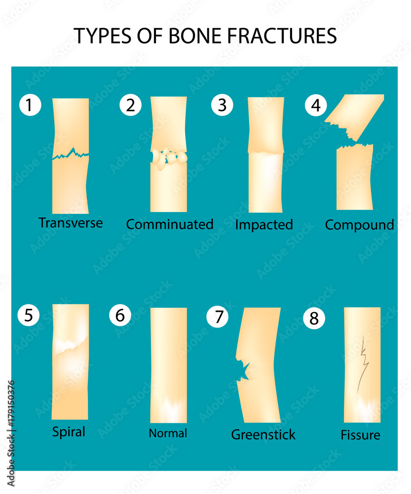 types of bone fractures Stock Vector | Adobe Stock
