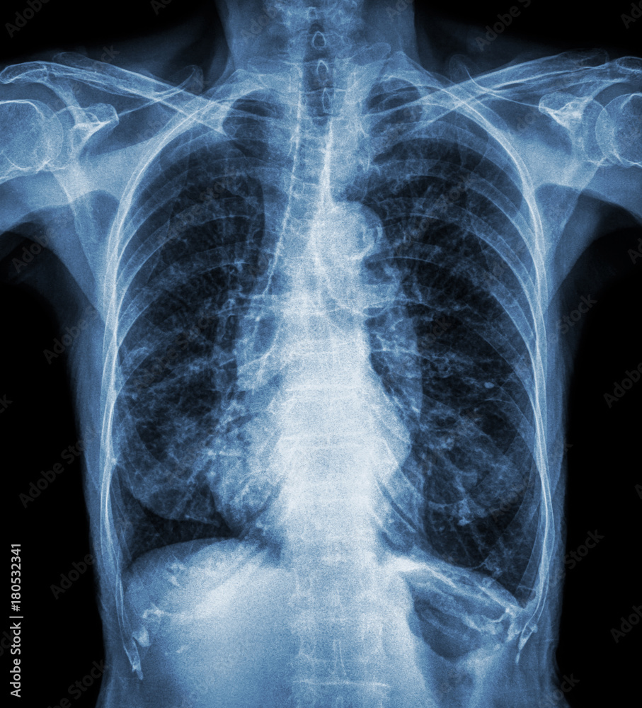 Normal chest X-ray of old patient . You can seen calcification at rib ...