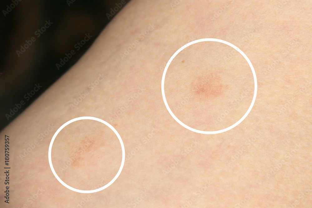 Pityriasis rosea three weeks after the appearance of the first focus on ...
