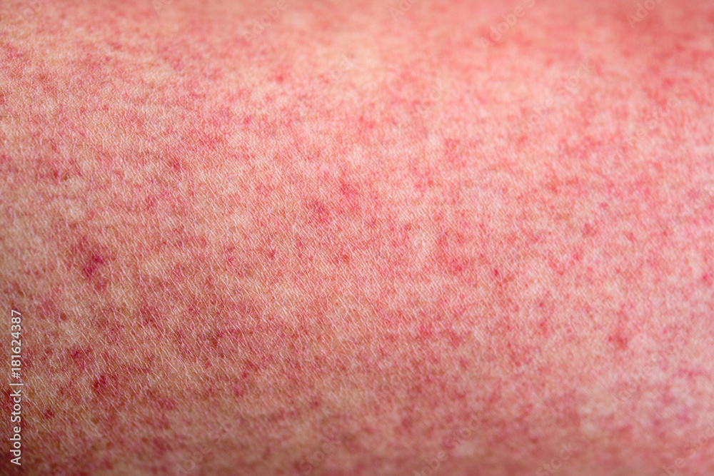 Skin with dengue fever red rashes Stock Photo | Adobe Stock