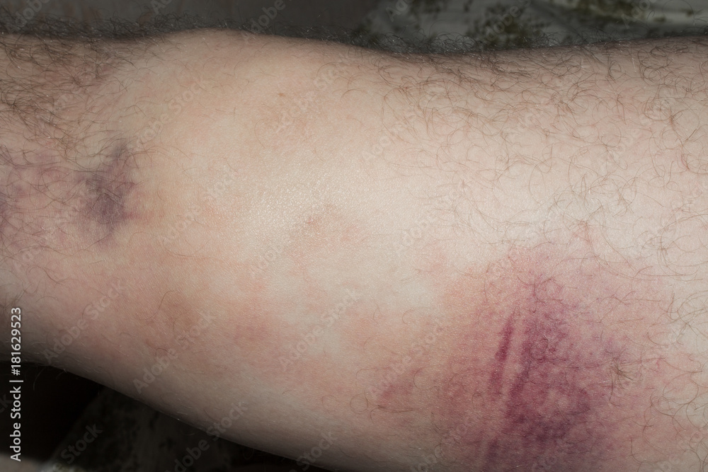 Стоковое фото «Swelling of the knee after dislocation of the kneecap ...