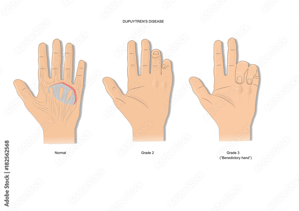 dupuytren's contracture (or disease): a condition where the palmar ...