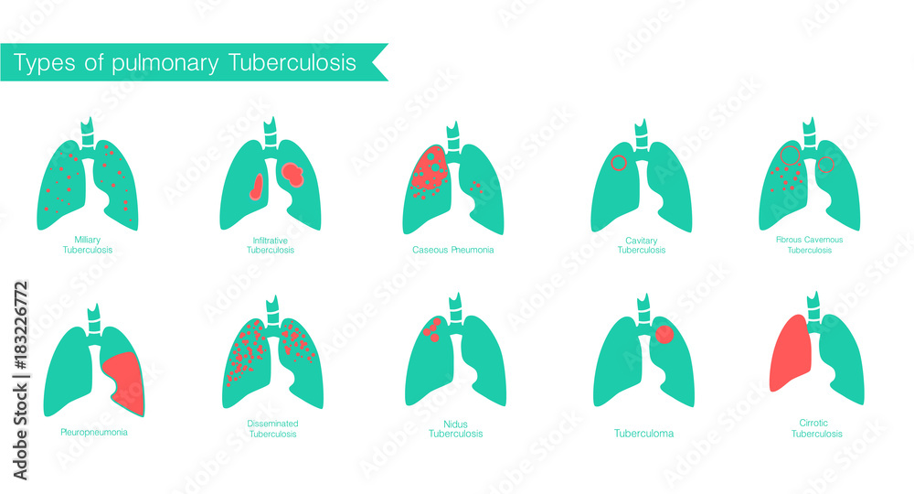 Types of tuberculosis. Vector silhouette medical Stock Vector | Adobe Stock