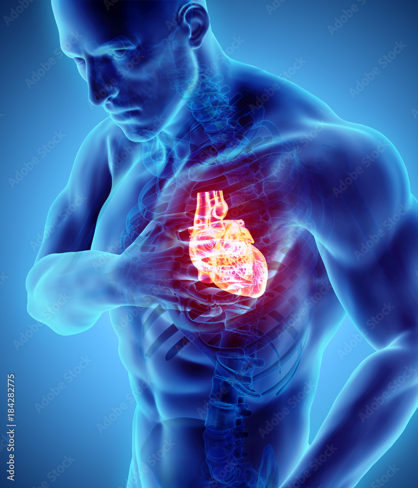 3d illustration of human heart attack. Stock Photo | Adobe Stock