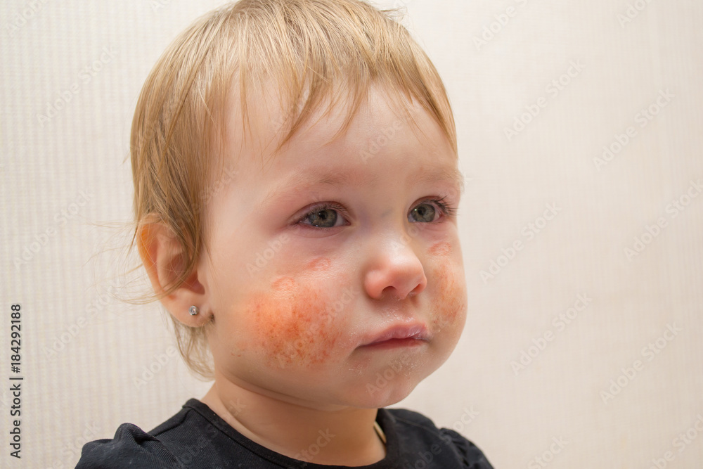 Foto de Stock Cute child 1 - 2 years old with eczema or allergic rash ...