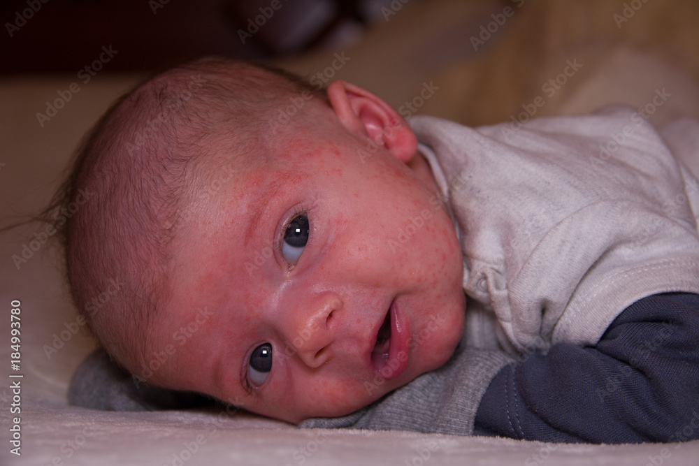 Foto de Stock baby allergy skin food. child dermatitis symptom problem ...
