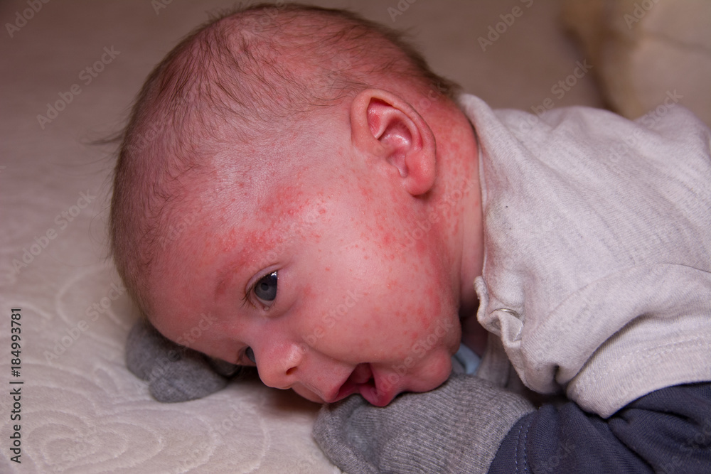 Photo Stock baby allergy skin food. child dermatitis symptom problem ...