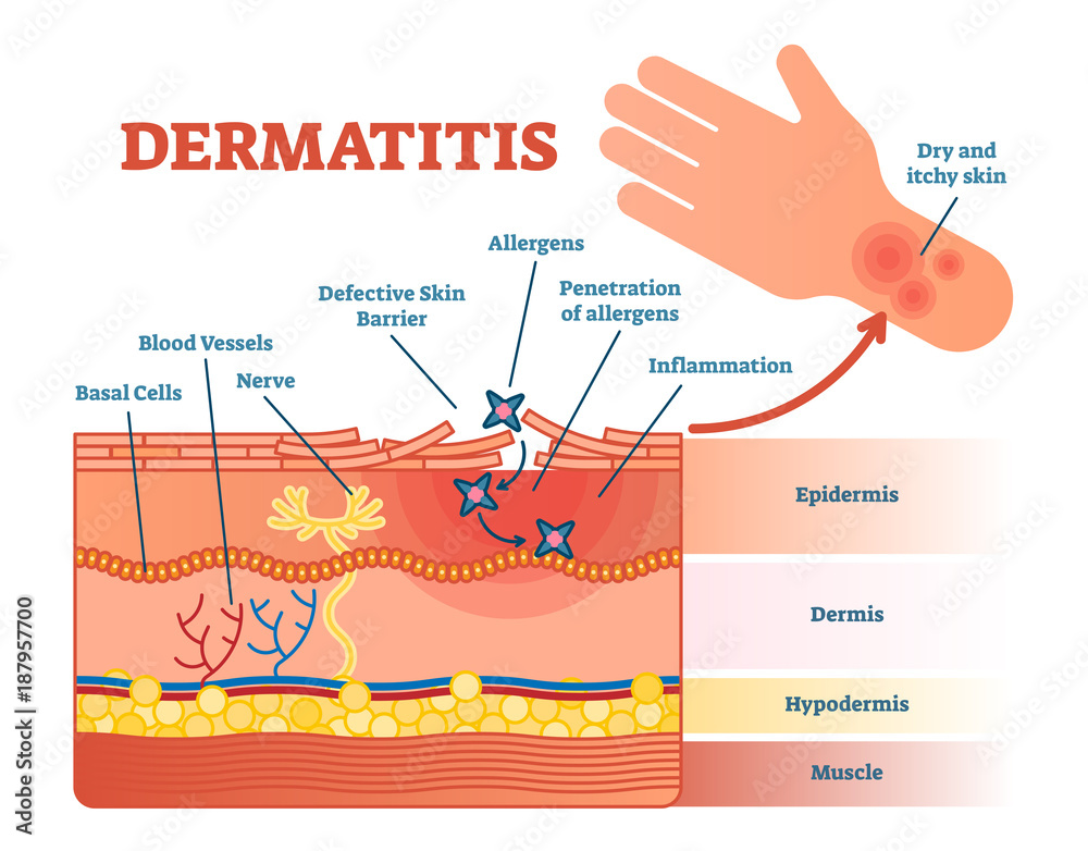 Dermatitis flat vector illustration diagram with skin layers and ...