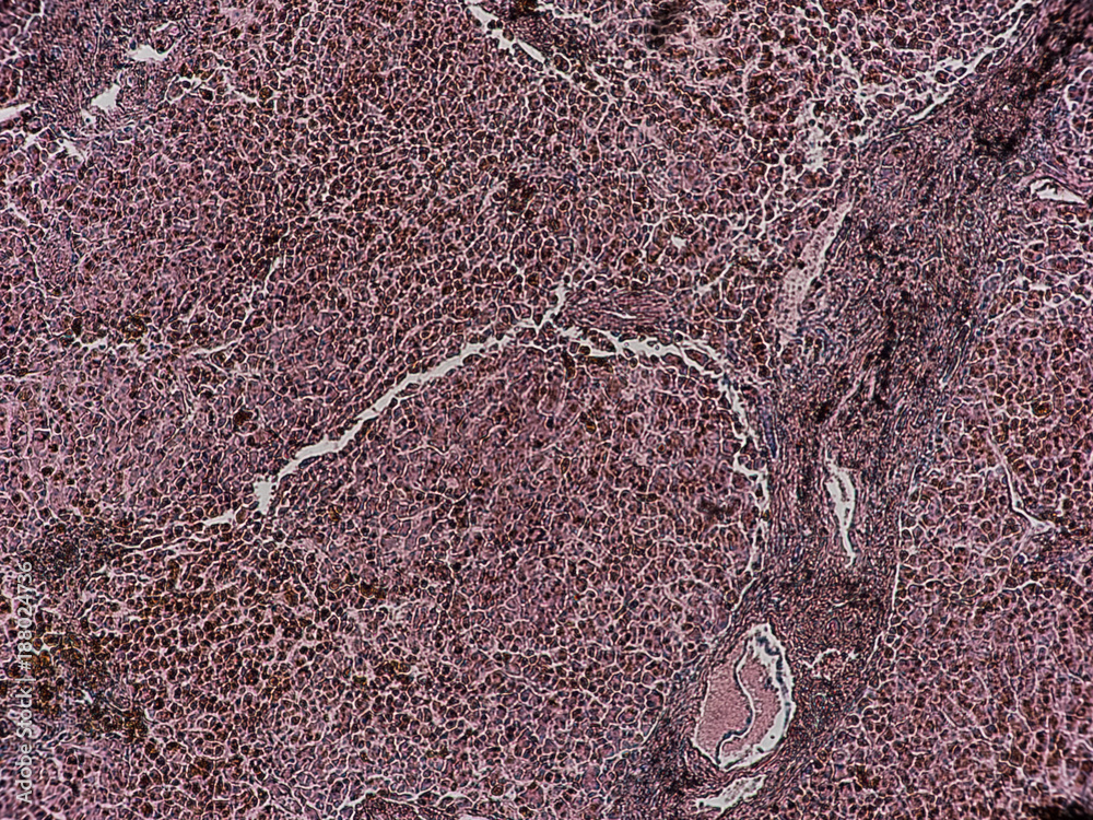 Human Pathology - Pigmentary cirrhosis of liver - Abnormal alterations ...