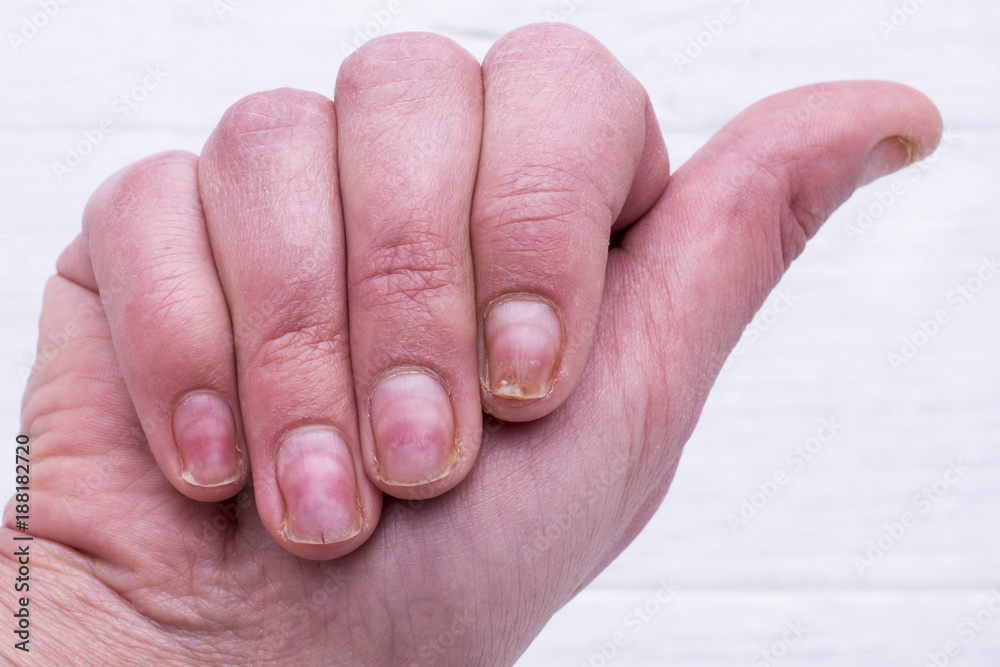 Damage of the nail after using shellac. Onycholysis. Injury of the nail ...