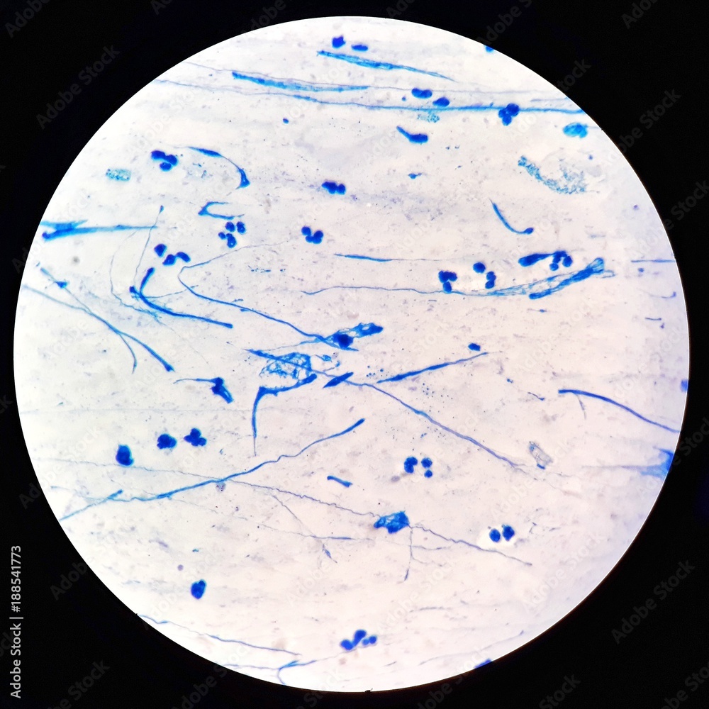 Smear of Acid-Fast bacilli (AFB) stained from sputum specimen, under ...
