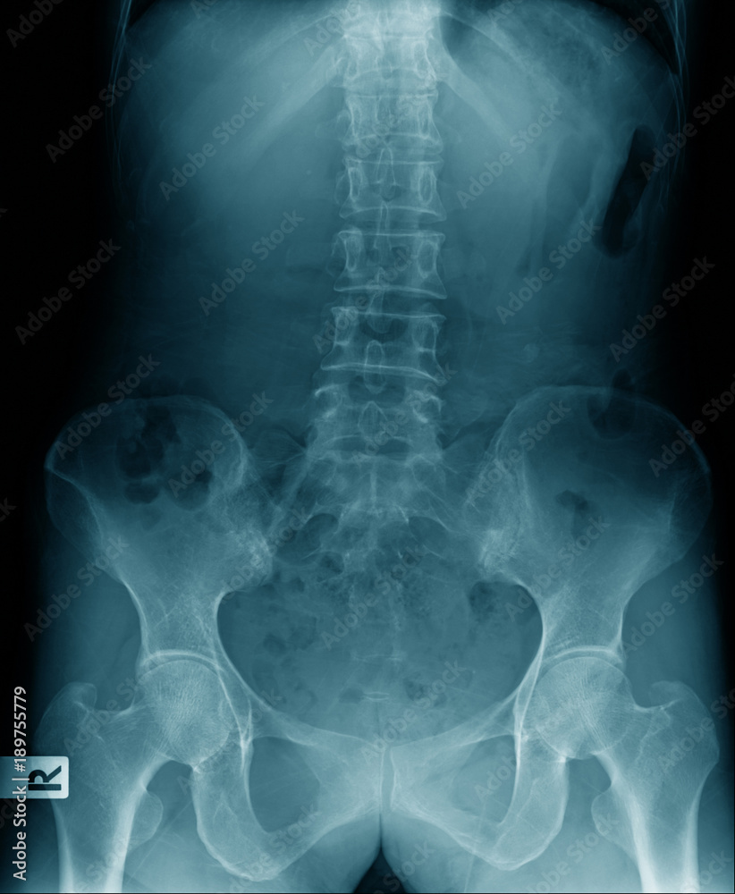 x-ray lower back with pelvic bone show lumbar spondylosis Stock Photo ...