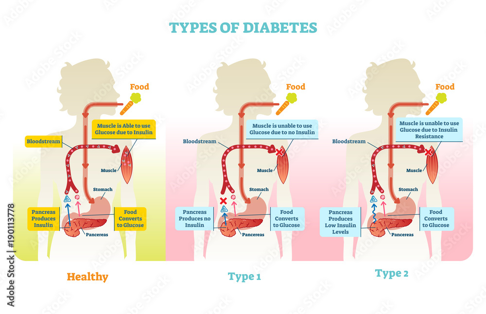 Types of diabetes vector illustration diagram scheme Stock Vector ...
