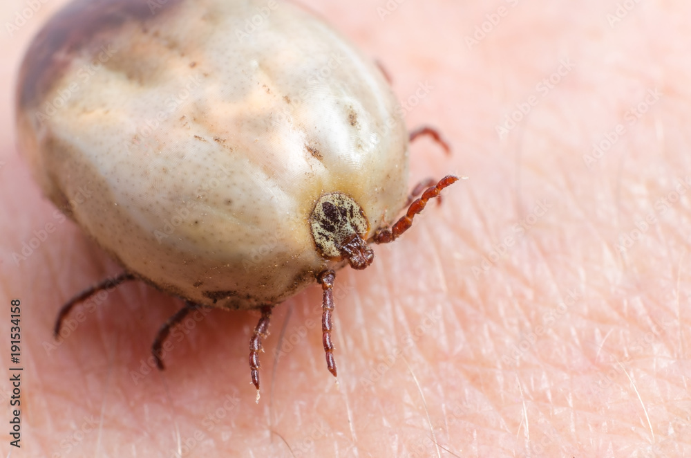 Tick filled with blood sitting on human skin Stock Photo | Adobe Stock