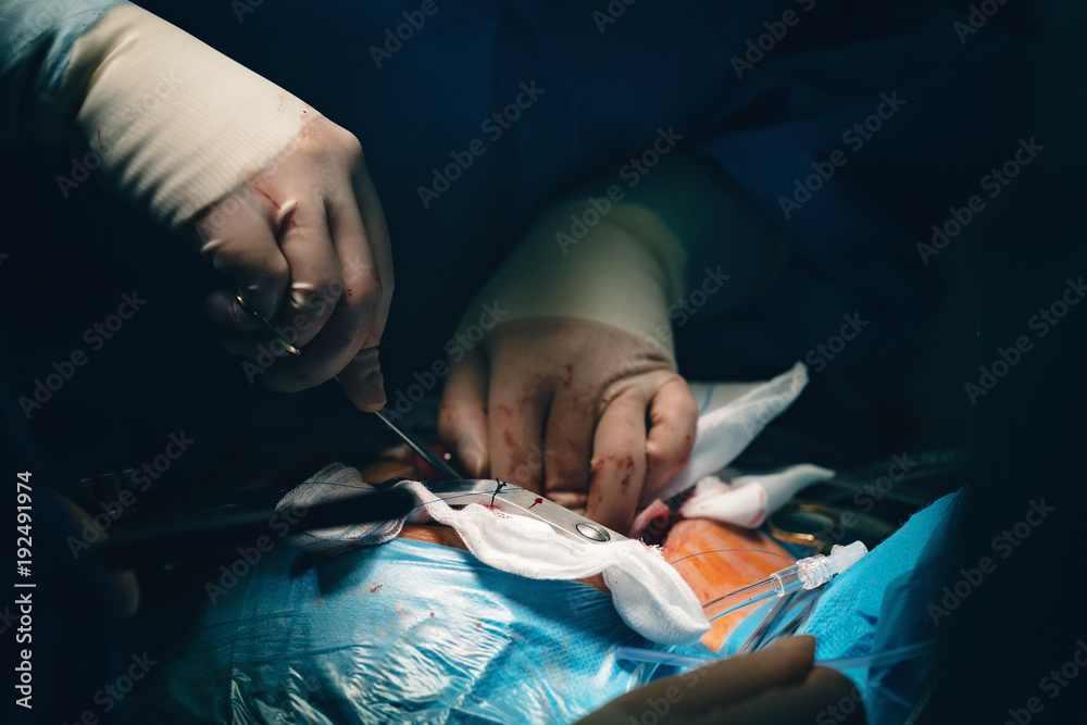 Needle holder or a needle driver in doctor's hand, a surgical ...