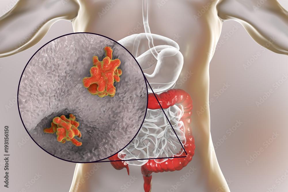 Entamoeba histolytica protozoan infection of large intestine. Parasite ...