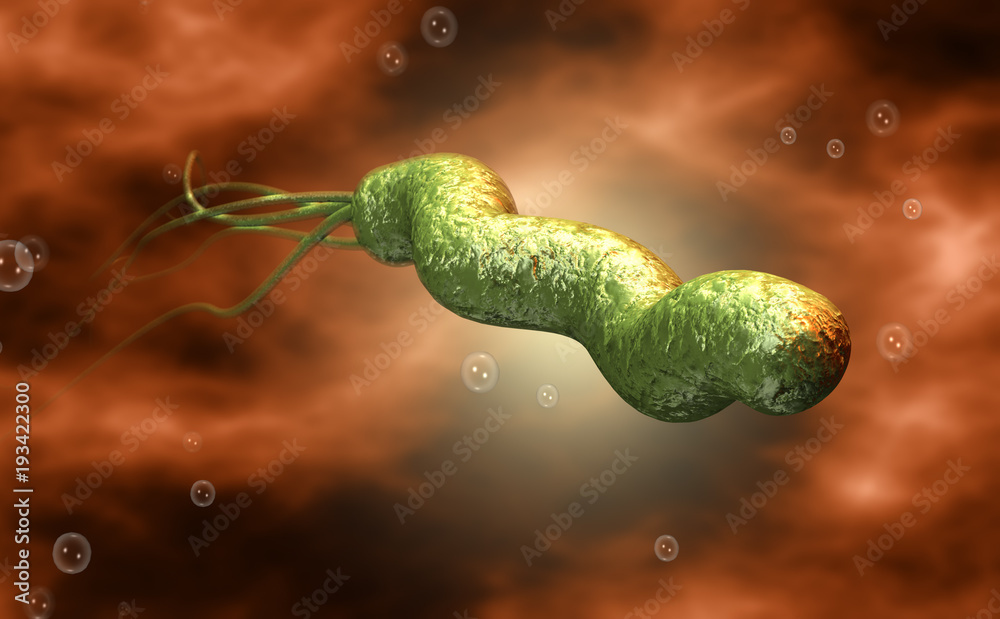 Helicobacter pylori bacterium in mucosa of stomach, stomach pain ...