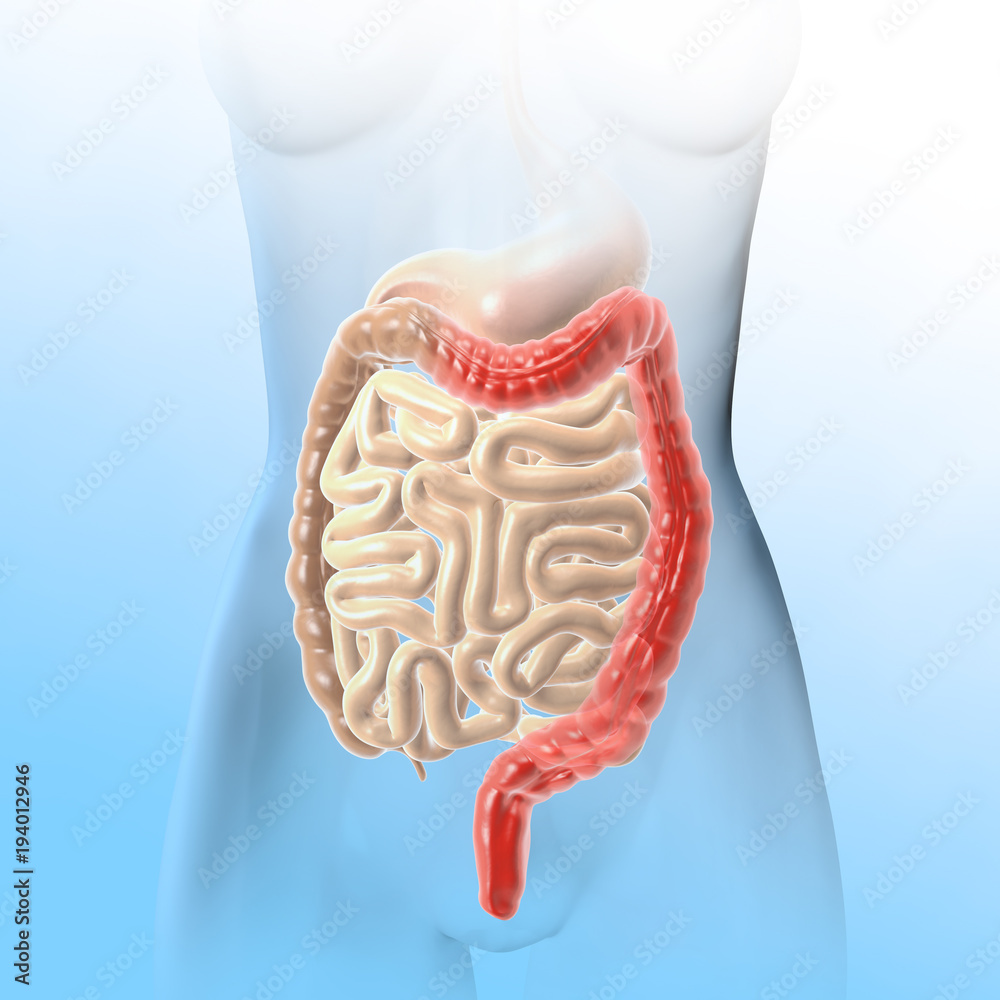 Ulcerative colitis (UC), inflammation and ulcers of the colon and ...