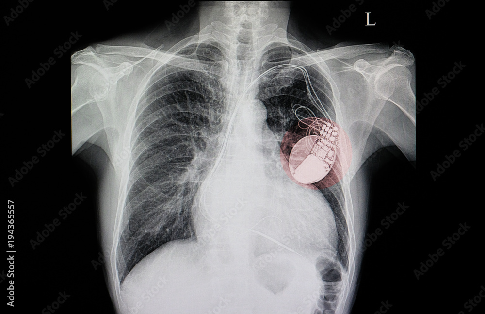 Chest x-ray film of a patient with cardiac pacemaker. Stock Photo ...