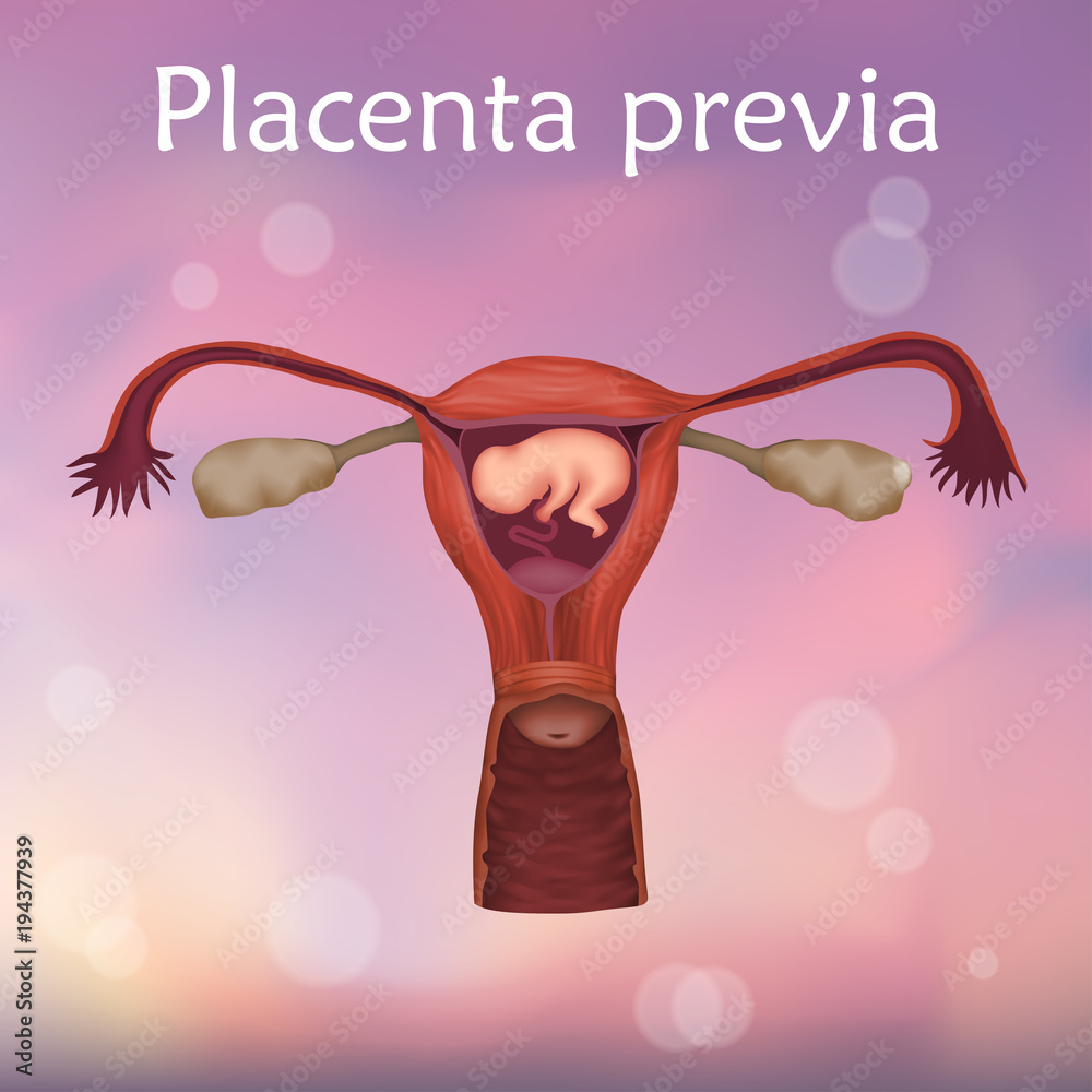 Placenta previa. Embryo, fetus in uterus, placenta, umbilical cord ...