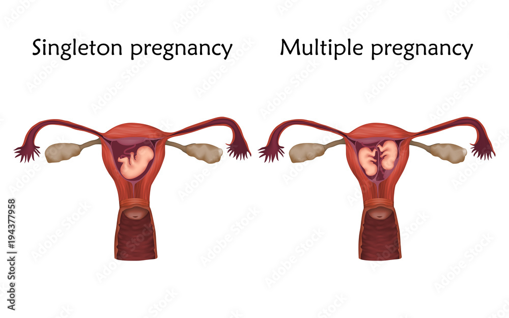 Multiple and singleton pregnancy, twins, embryo, fetus in uterus ...