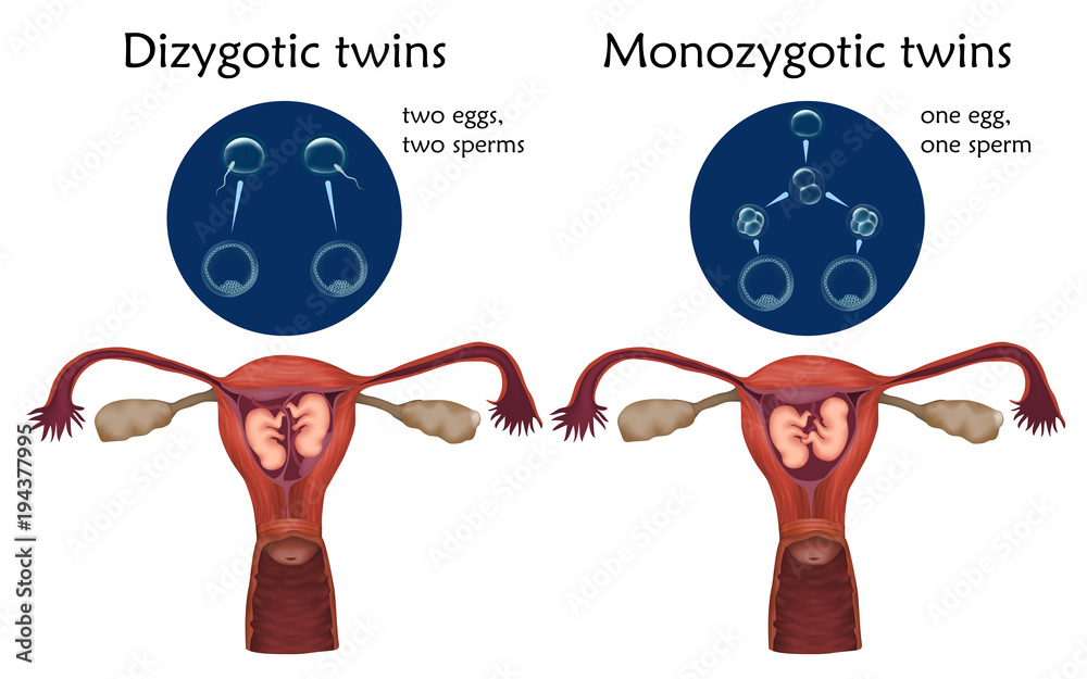 Vector de Stock Multiple pregnancy. Dizygotic and monozygotic twins ...