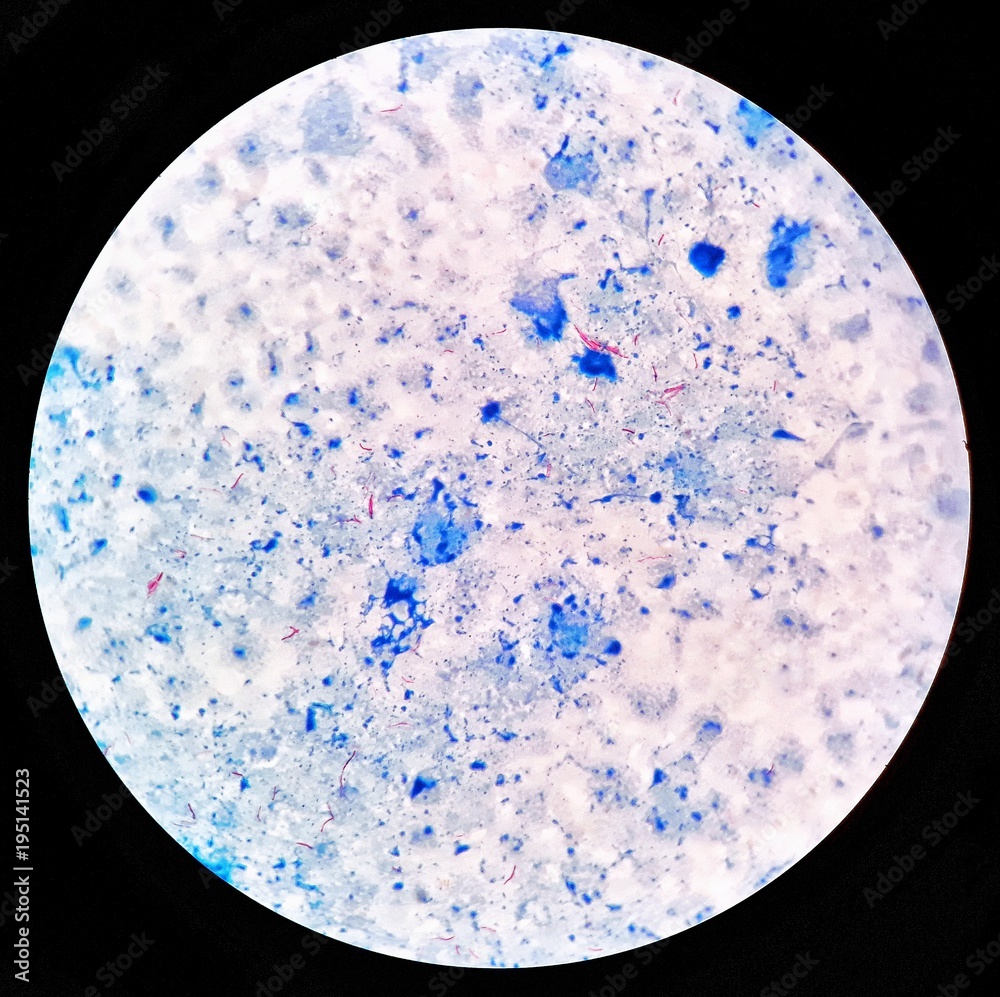 Photo Stock Smear of positive Acid-Fast bacilli (AFB) bacteria stained ...