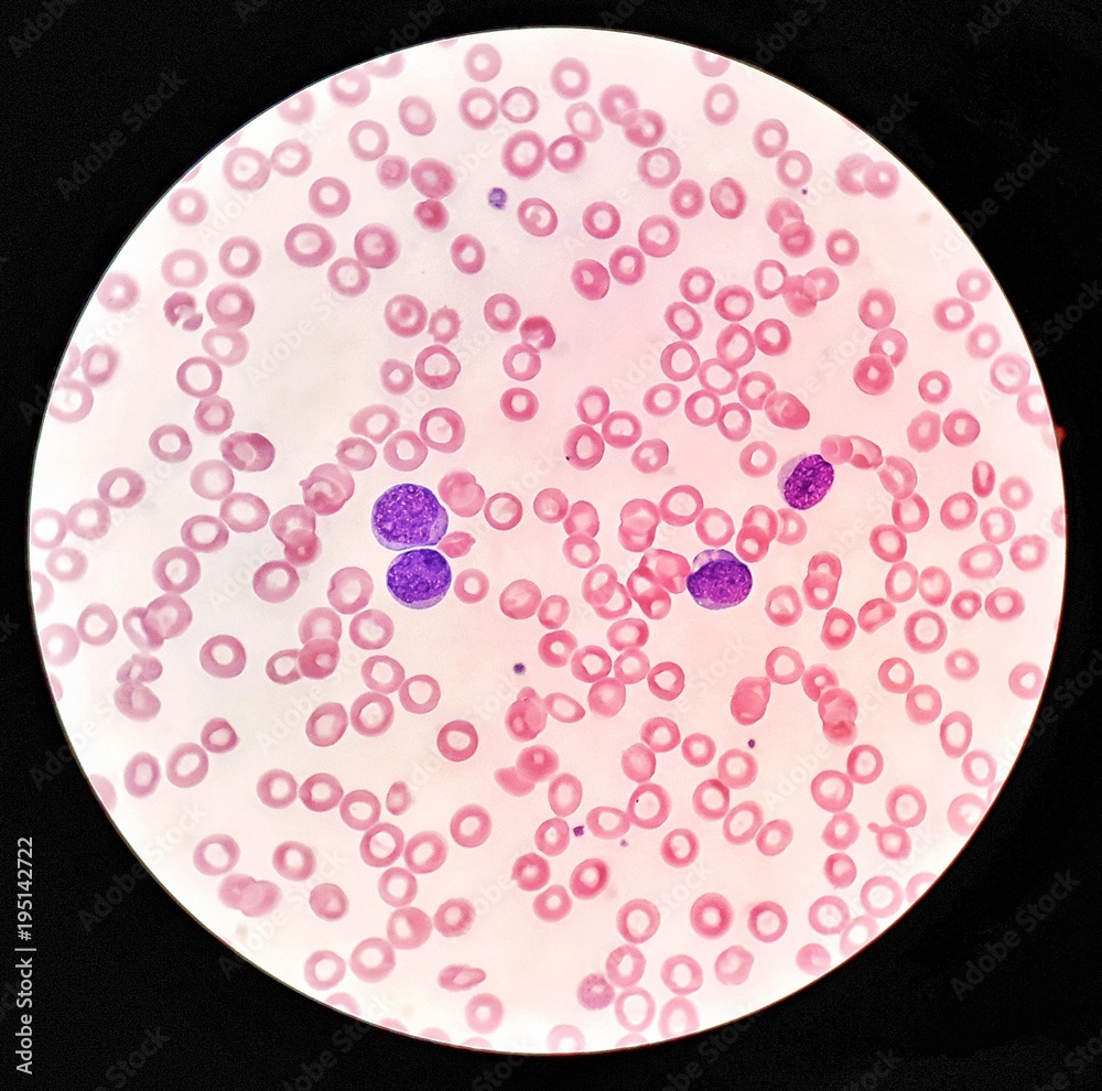 Human blood smear under 100X light microscope with blast cells and ...