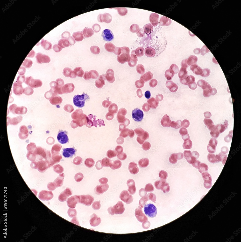 Human blood smear under 100X light microscope with atypical lymphocytes ...