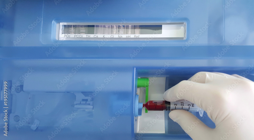 Arterial blood gas test measures the acidity and the levels of oxygen ...